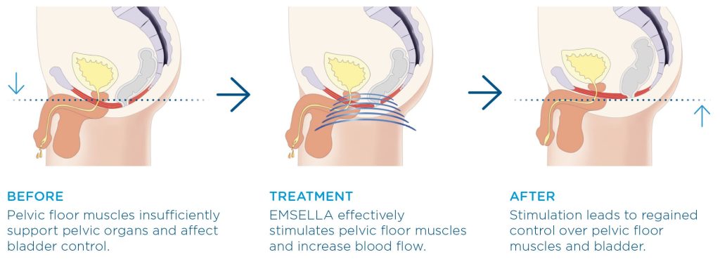 Emsella | HIFEM That Targets the Pelvic-Floor | Dr Yusra
