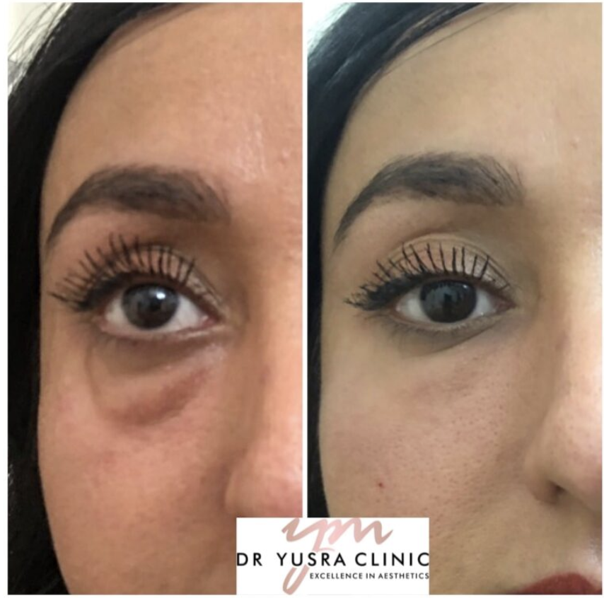 Tear Trough Fillers UK | Natural Under-Eye Rejuvenation at Dr Yusra Clinic