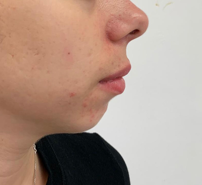 Treatments For Weak Chin Non Surgical Solution Dr Yusra Treatments For Weak Chin Non Surgical Solution Dr Yusra